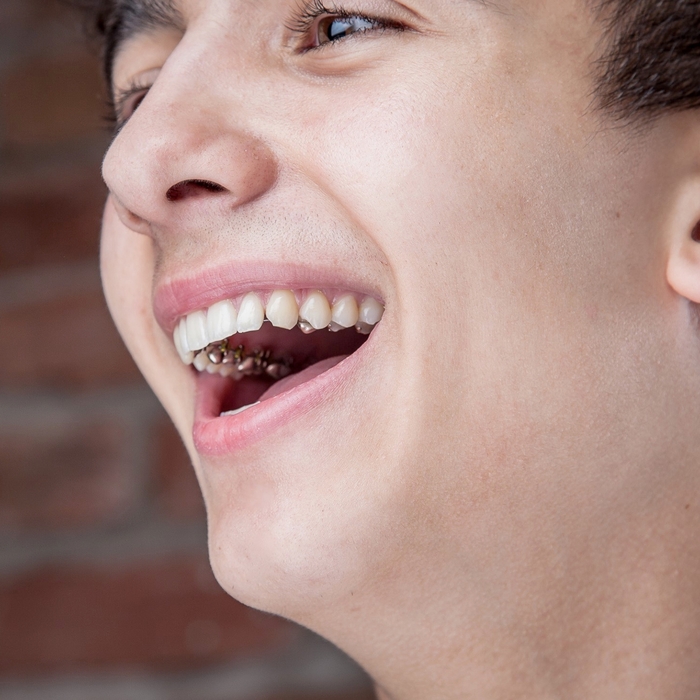 Lingual Braces | Santa Clarita, California | Kidz Dental Care SCV and PR