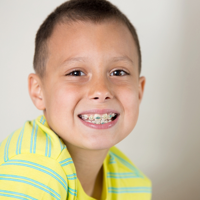 Types of Braces | Santa Clarita, California | Kidz Dental Care SCV and PR
