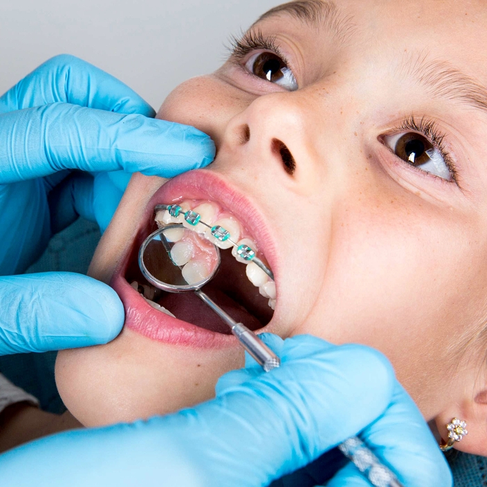 Repositioning Teeth with Orthodontic Appliances | Santa Clarita, California | Kidz Dental Care ...